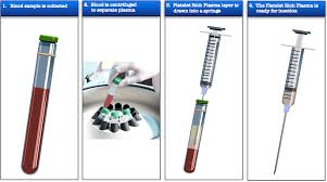 Global Platelet Rich Plasma (PRP) Market 2019 – T-Biotechnology (T-LAB ...