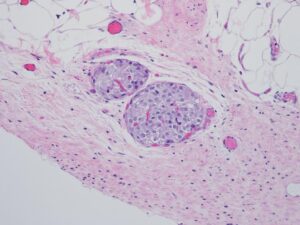 Antioxidant Gel Preserves Function of Pancreatic Islets Transplanted ...