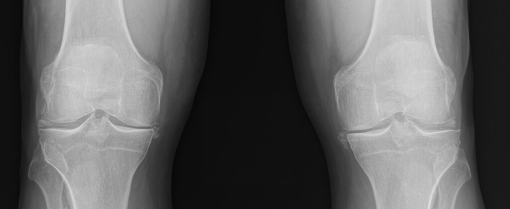 Genetic Links for Common Inflammatory Arthritis Open Treatment Options ...
